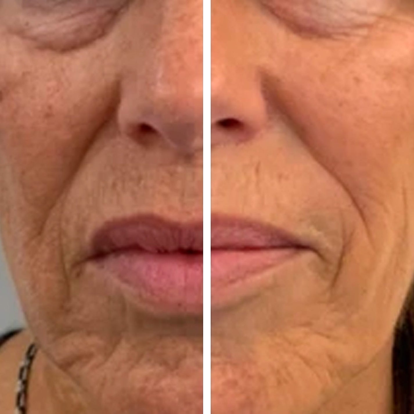 The LYMA Laser – Shop Diamond Face Institute
